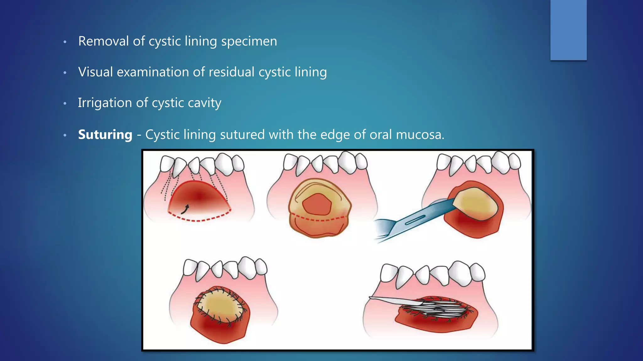 Management of cyst | PPTX