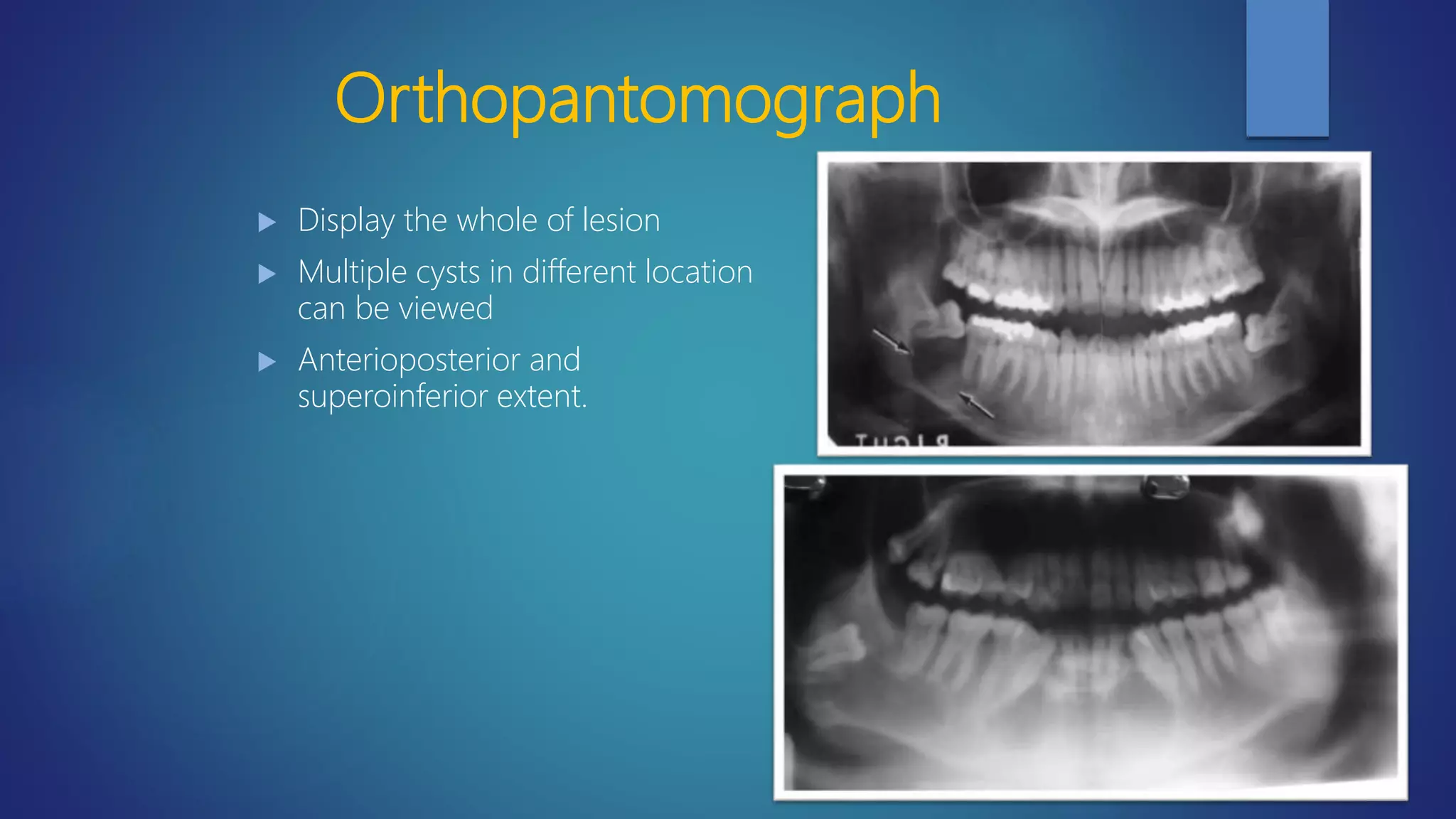 Management of cyst | PPTX