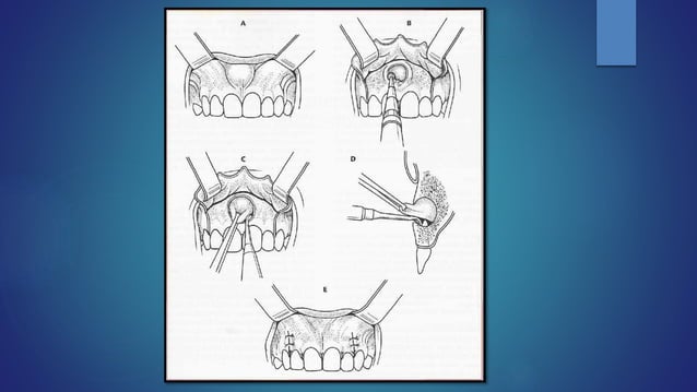 Management of cyst | PPTX
