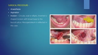 Management of cyst | PPTX