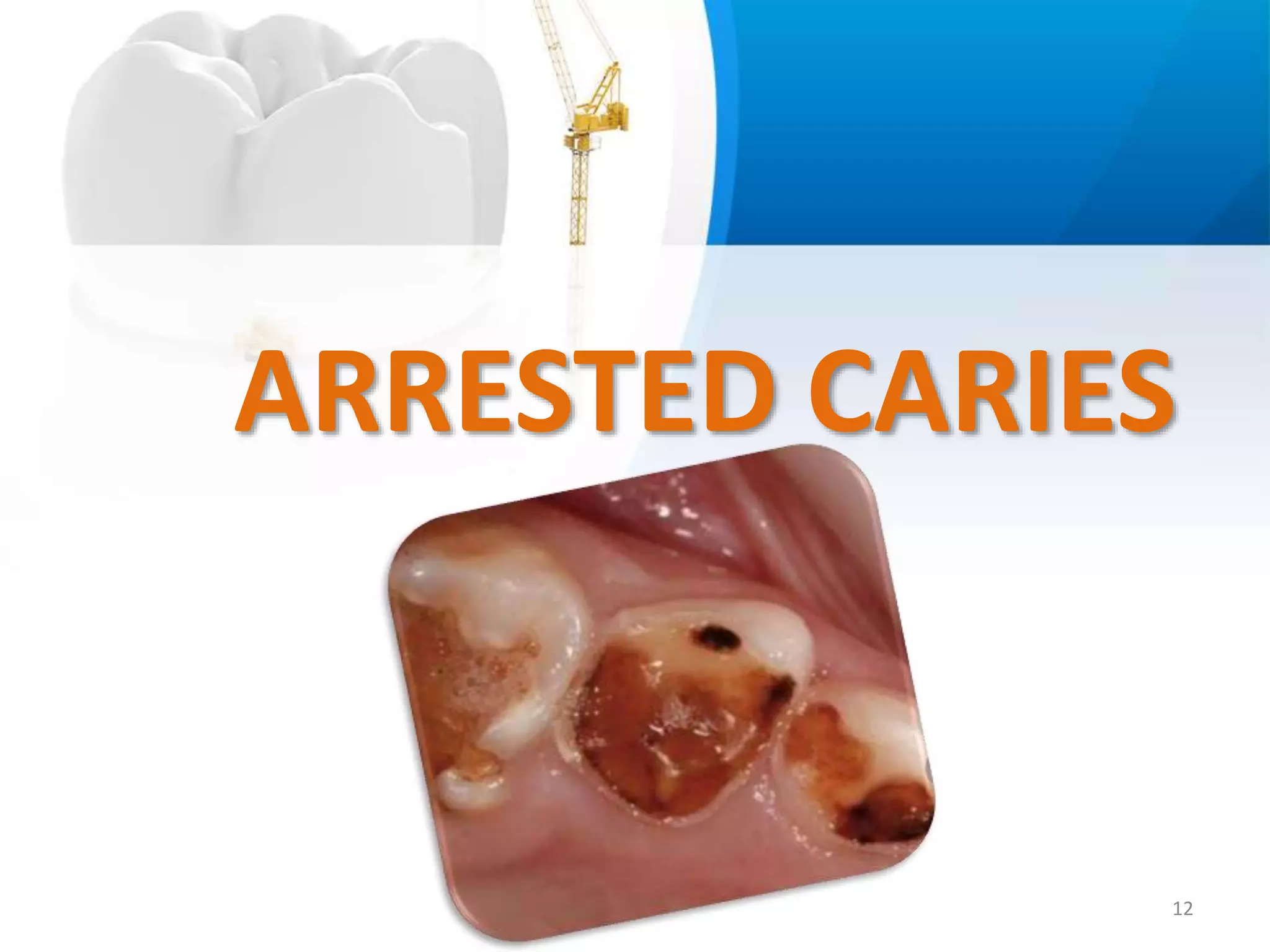 Management of deep carious lesions | PPTX