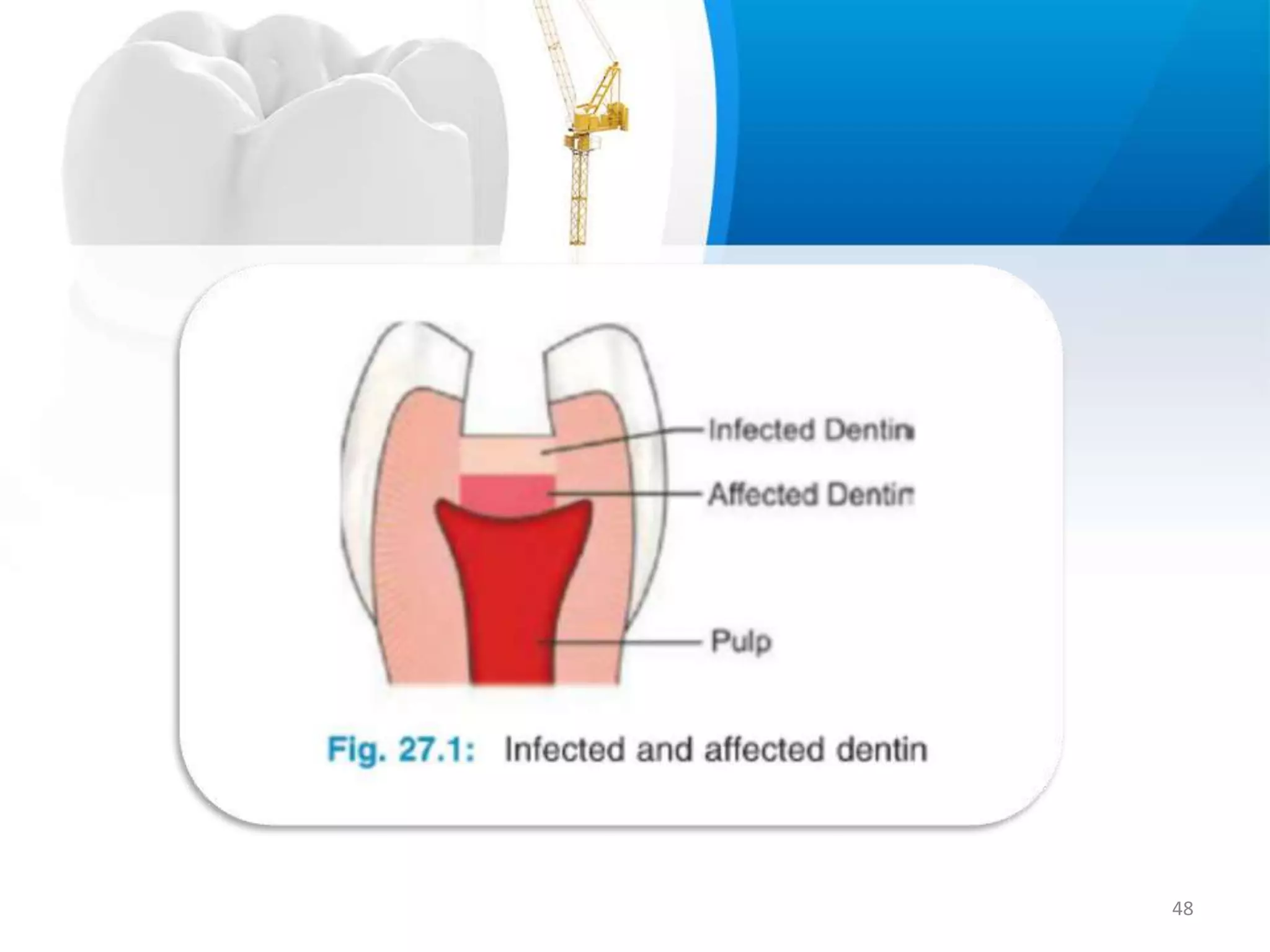 Management of deep carious lesions | PPTX