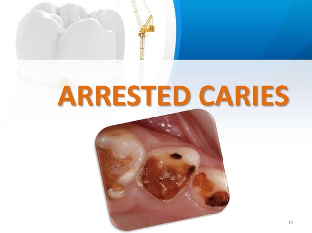 Management of deep carious lesions | PPTX | Dental Health | Diseases ...