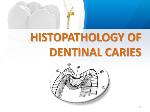 Management of deep carious lesions | PPTX | Dental Health | Diseases ...