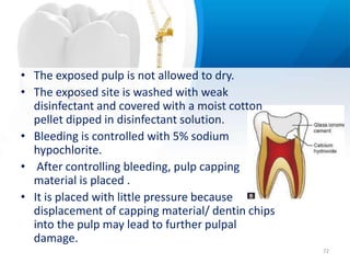 Management of deep carious lesions | PPTX
