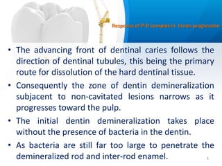 Management of deep carious lesions | PPTX