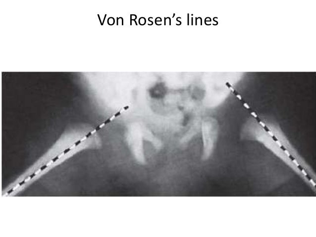 Management of Develpmental Dysplasia of the Hip