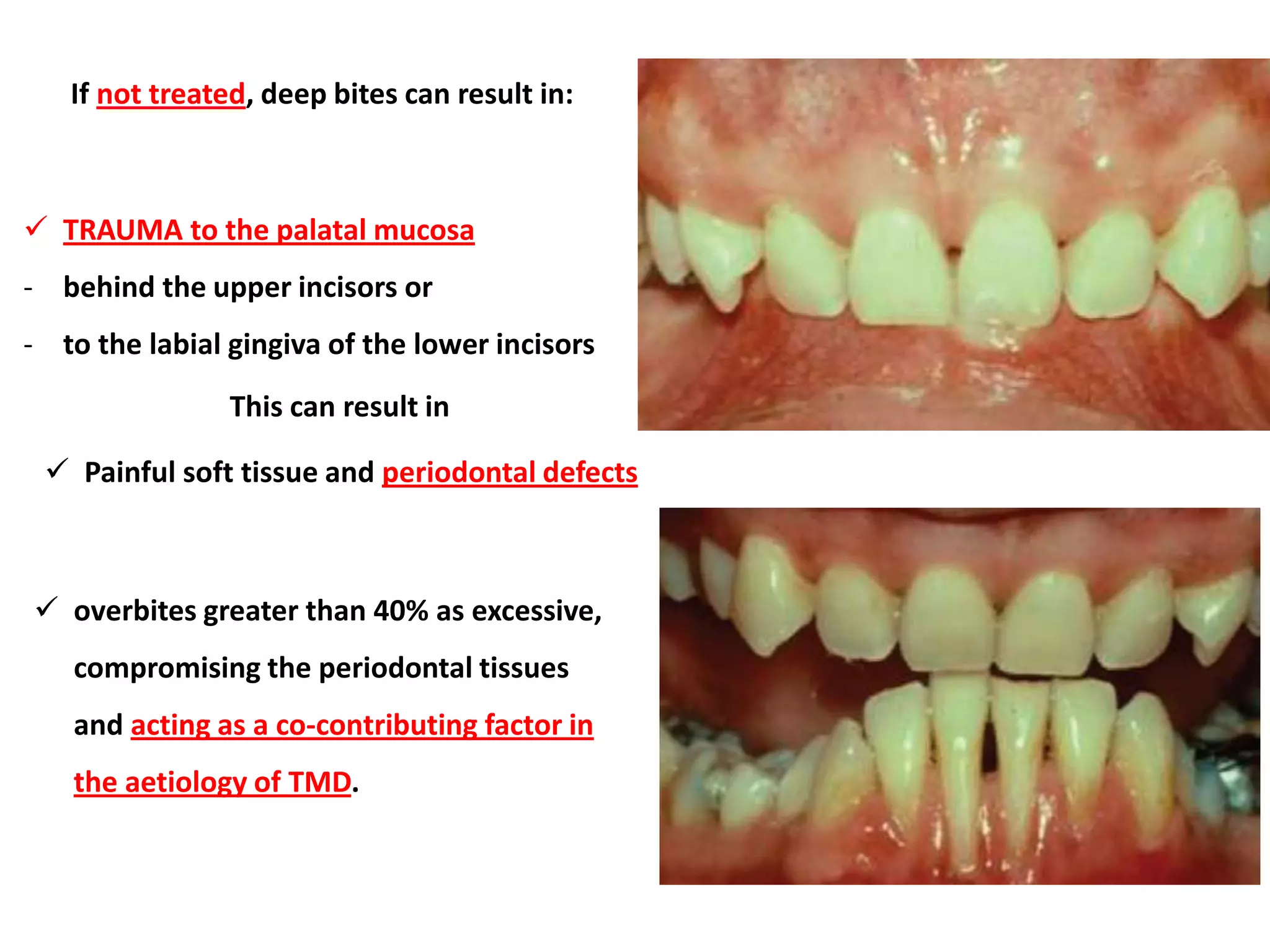 Management of Deep Bite _ Dr. Nabil Al-Zubair | PDF