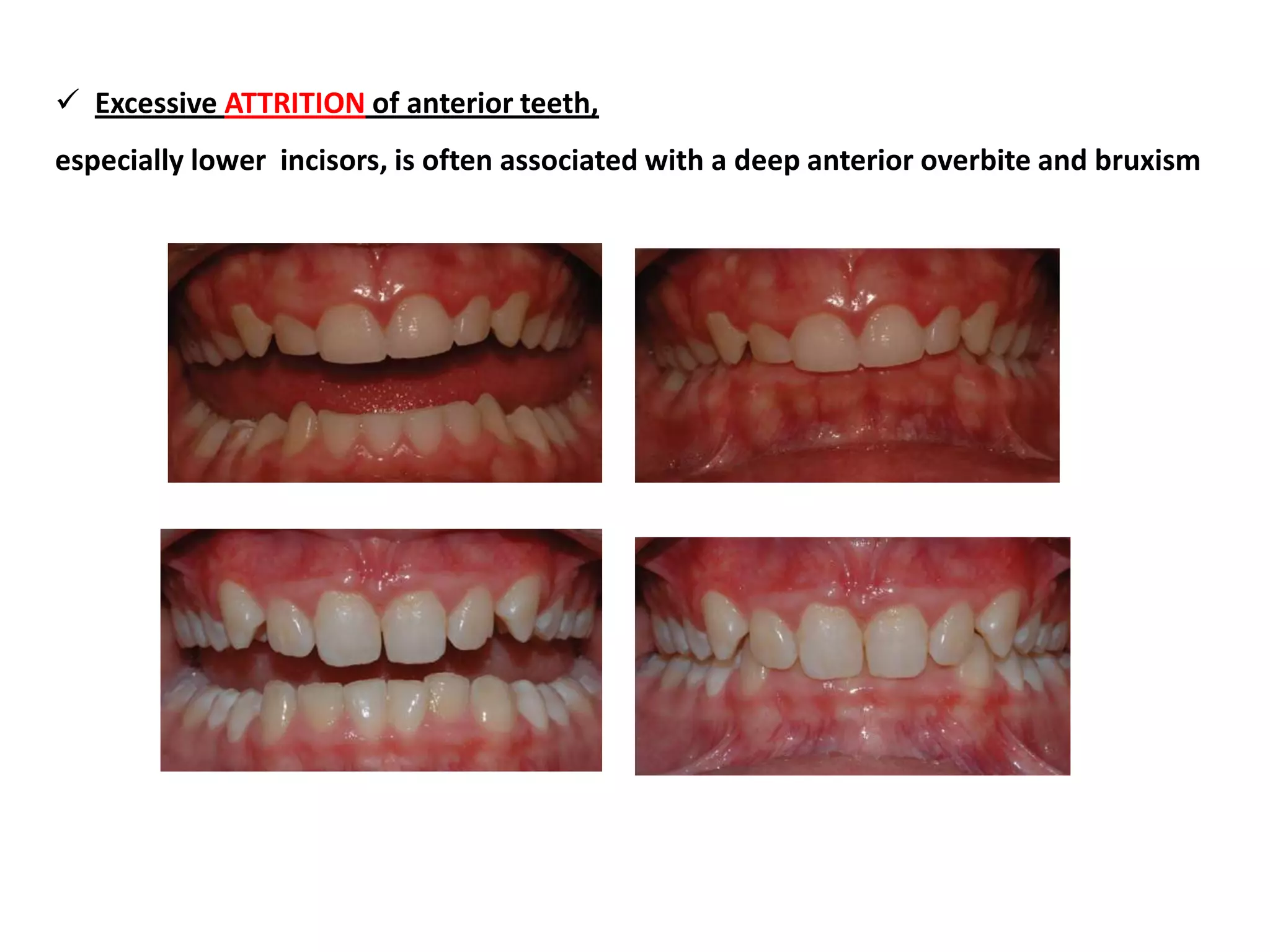 Management of Deep Bite _ Dr. Nabil Al-Zubair | PDF