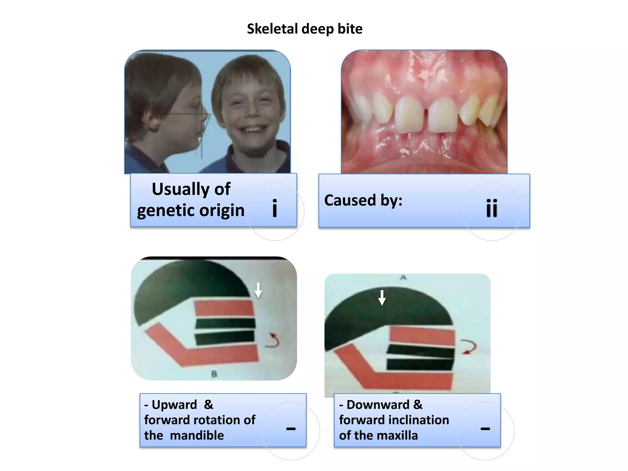 Management of Deep Bite _ Dr. Nabil Al-Zubair | PDF