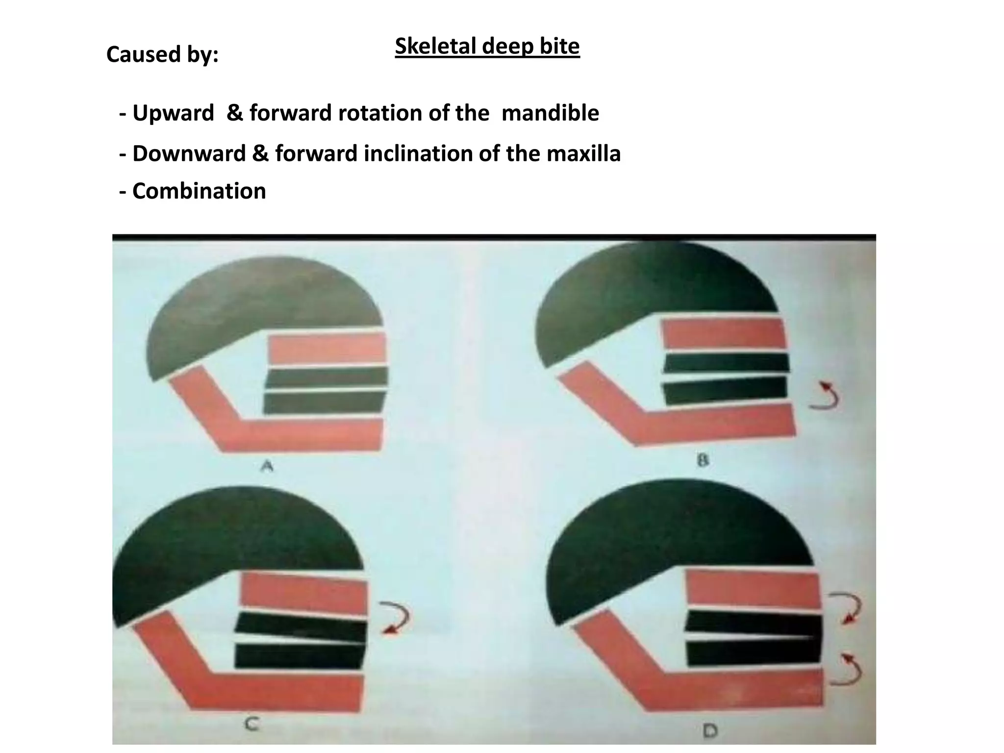 Management of Deep Bite _ Dr. Nabil Al-Zubair | PDF