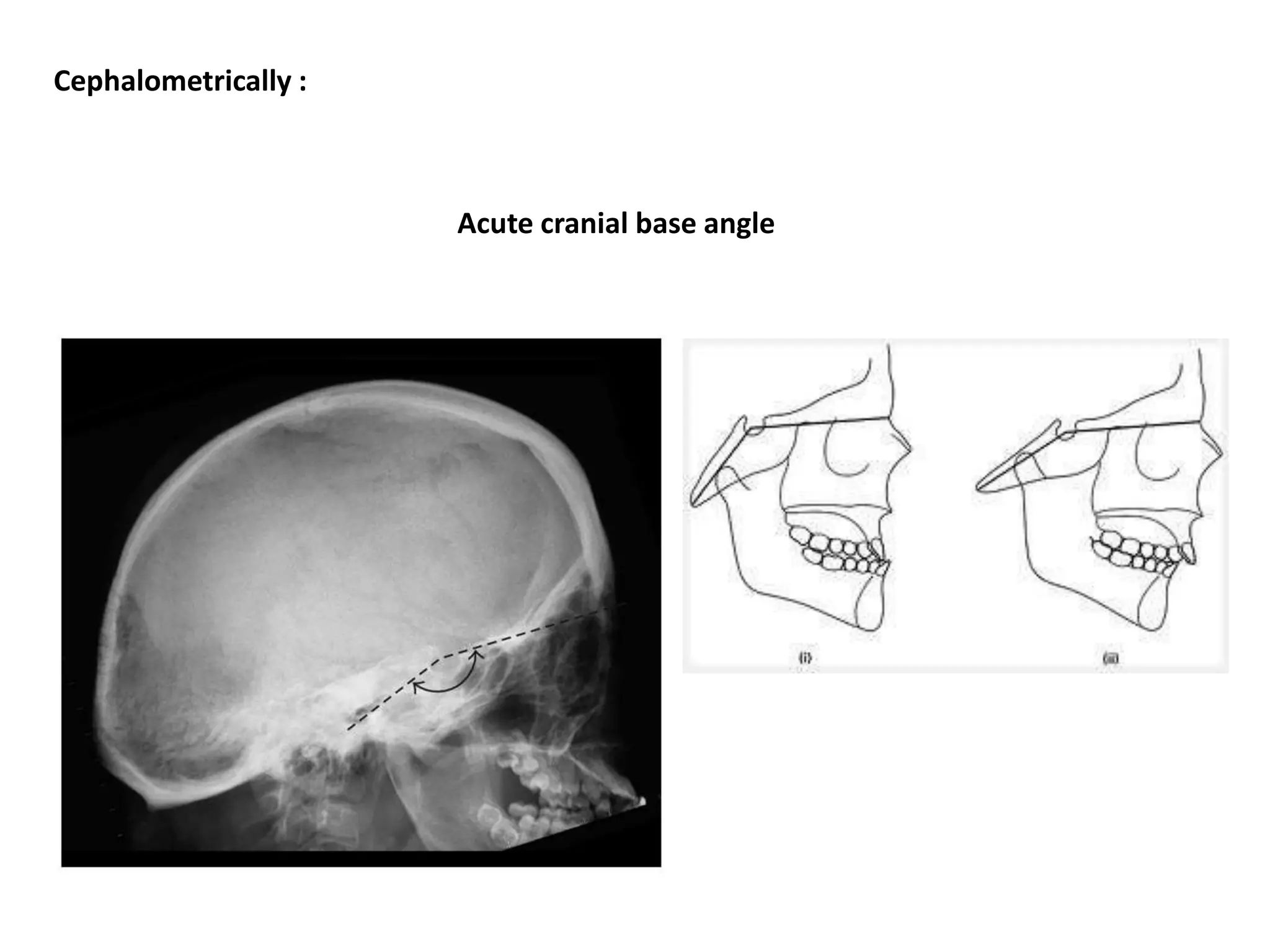 Management of Deep Bite _ Dr. Nabil Al-Zubair | PDF