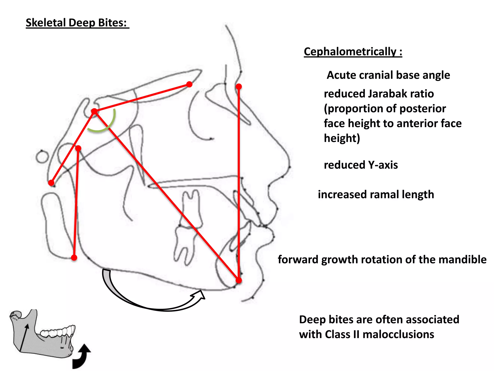 Management of Deep Bite _ Dr. Nabil Al-Zubair | PDF | Dental Health ...