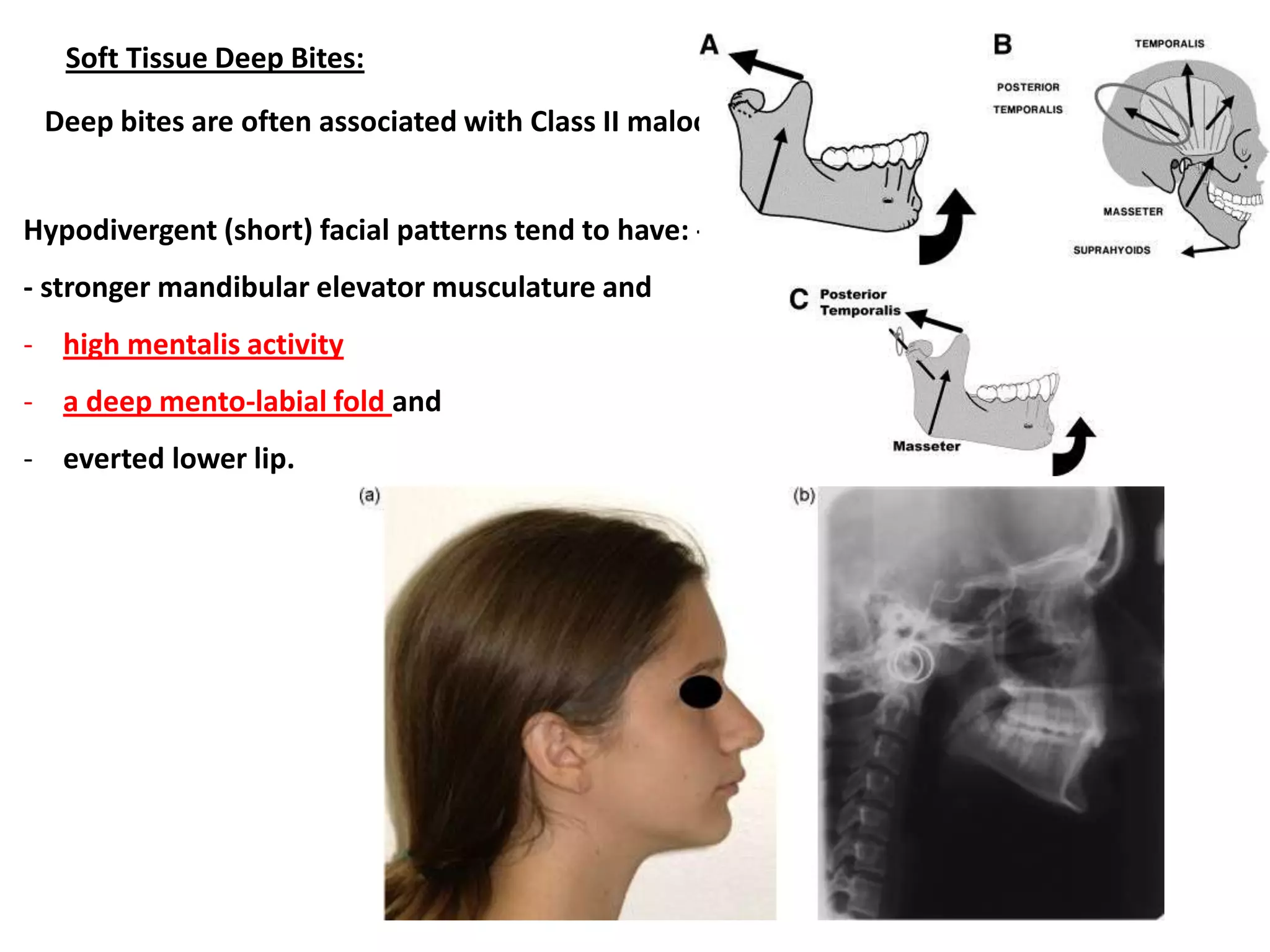 Management of Deep Bite _ Dr. Nabil Al-Zubair | PDF