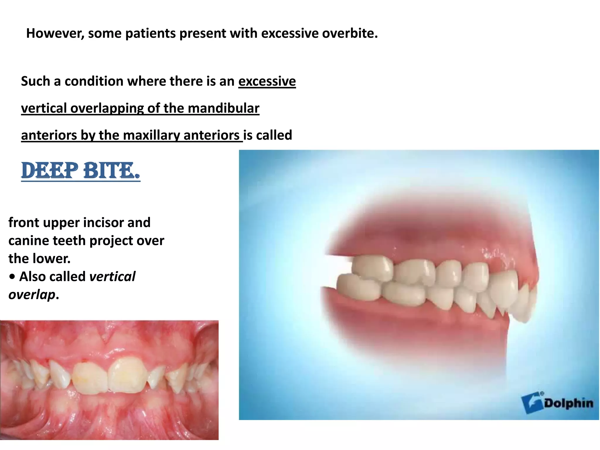 Management of Deep Bite _ Dr. Nabil Al-Zubair | PDF