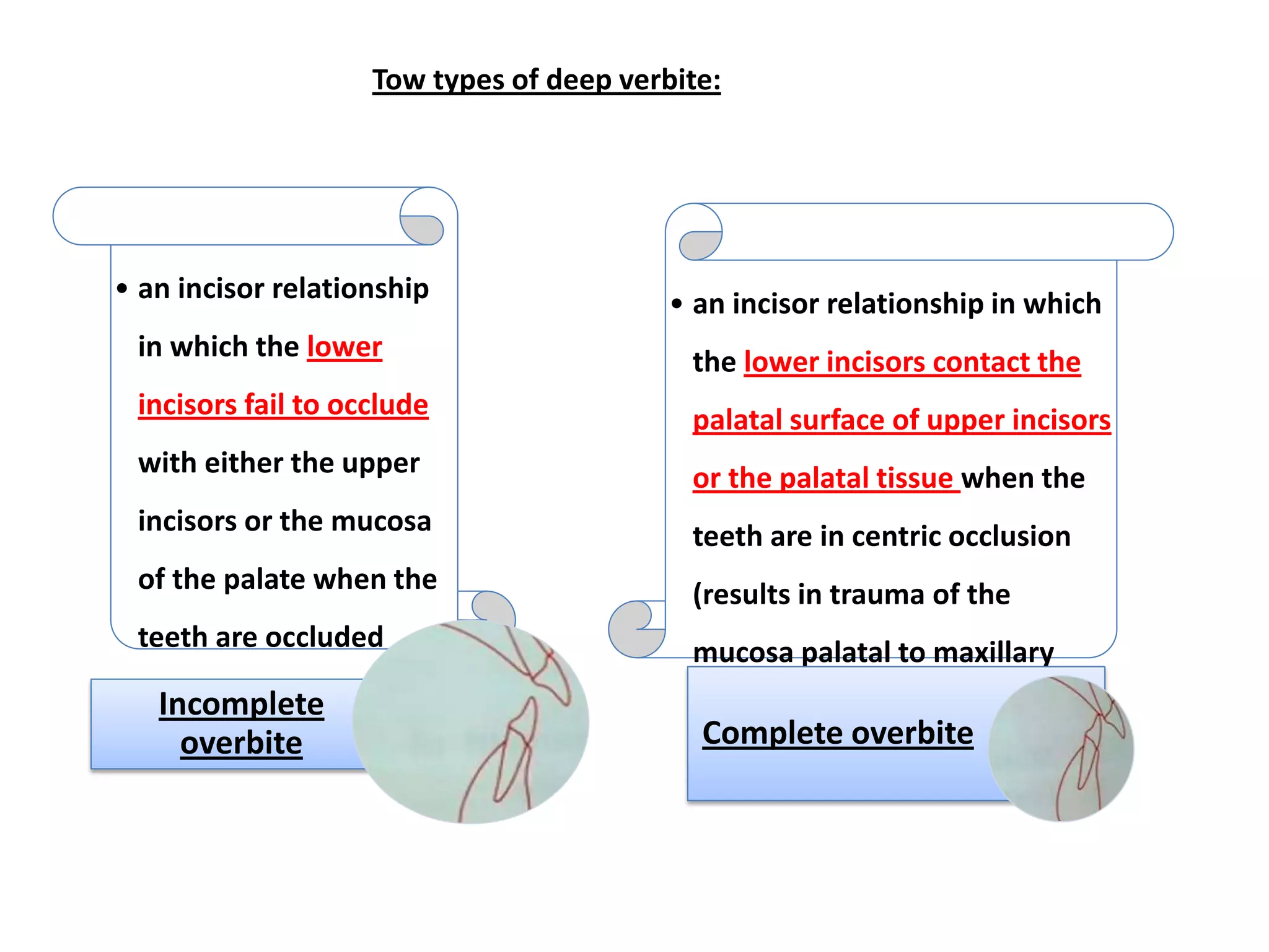 Management of Deep Bite _ Dr. Nabil Al-Zubair | PDF