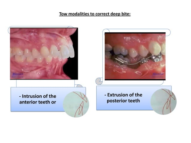 Management of Deep Bite _ Dr. Nabil Al-Zubair | PDF | Dental Health ...