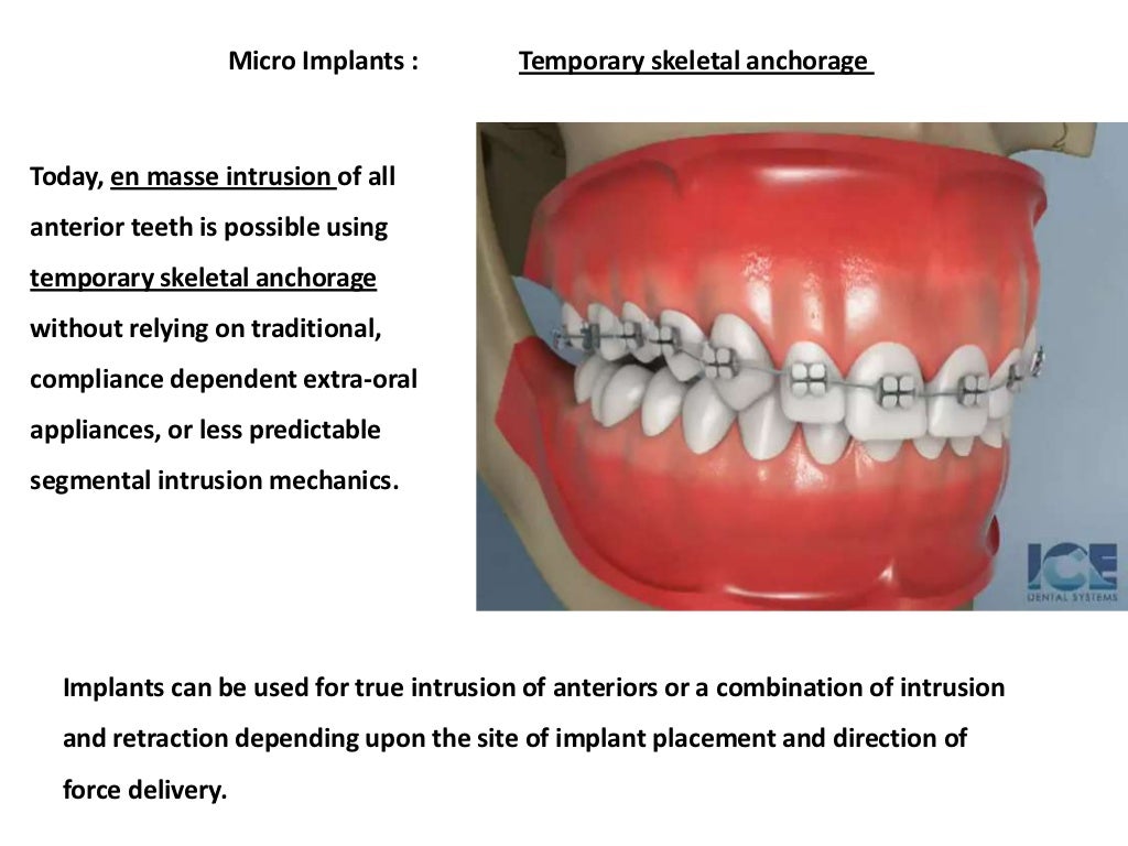 Management of Deep Bite _ Dr. Nabil Al-Zubair