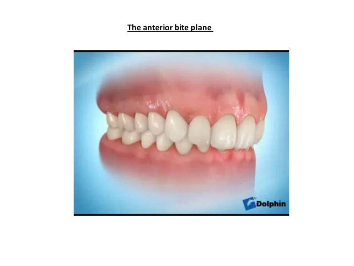 Management of Deep Bite _ Dr. Nabil Al-Zubair