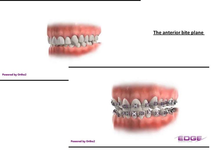 Management of Deep Bite _ Dr. Nabil Al-Zubair