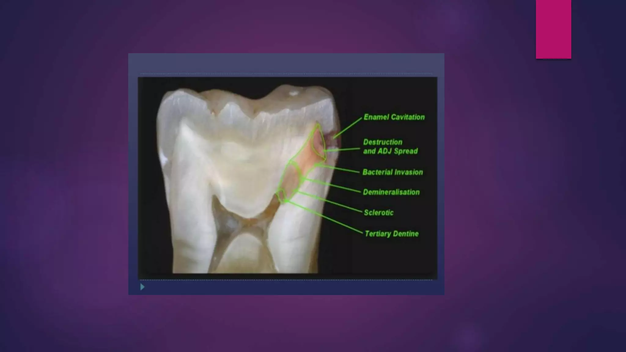 Management of deep carious | PPTX