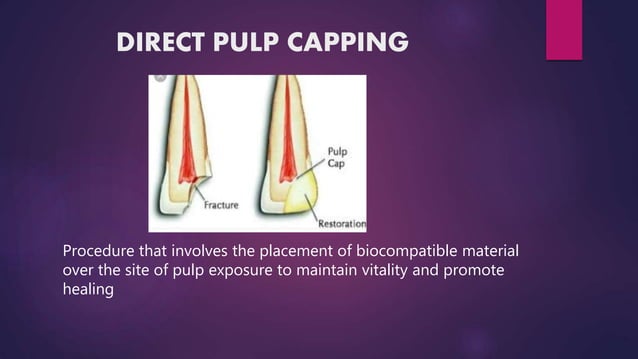 Management of deep carious | PPTX