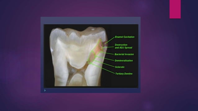 Management of deep carious | PPTX