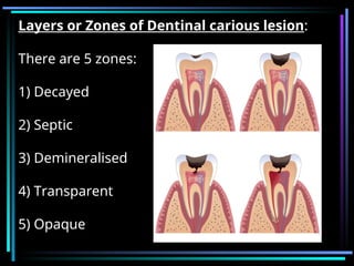 Management of Deep carious lesion (1).ppt
