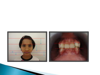 Management of deep overbite | PPTX