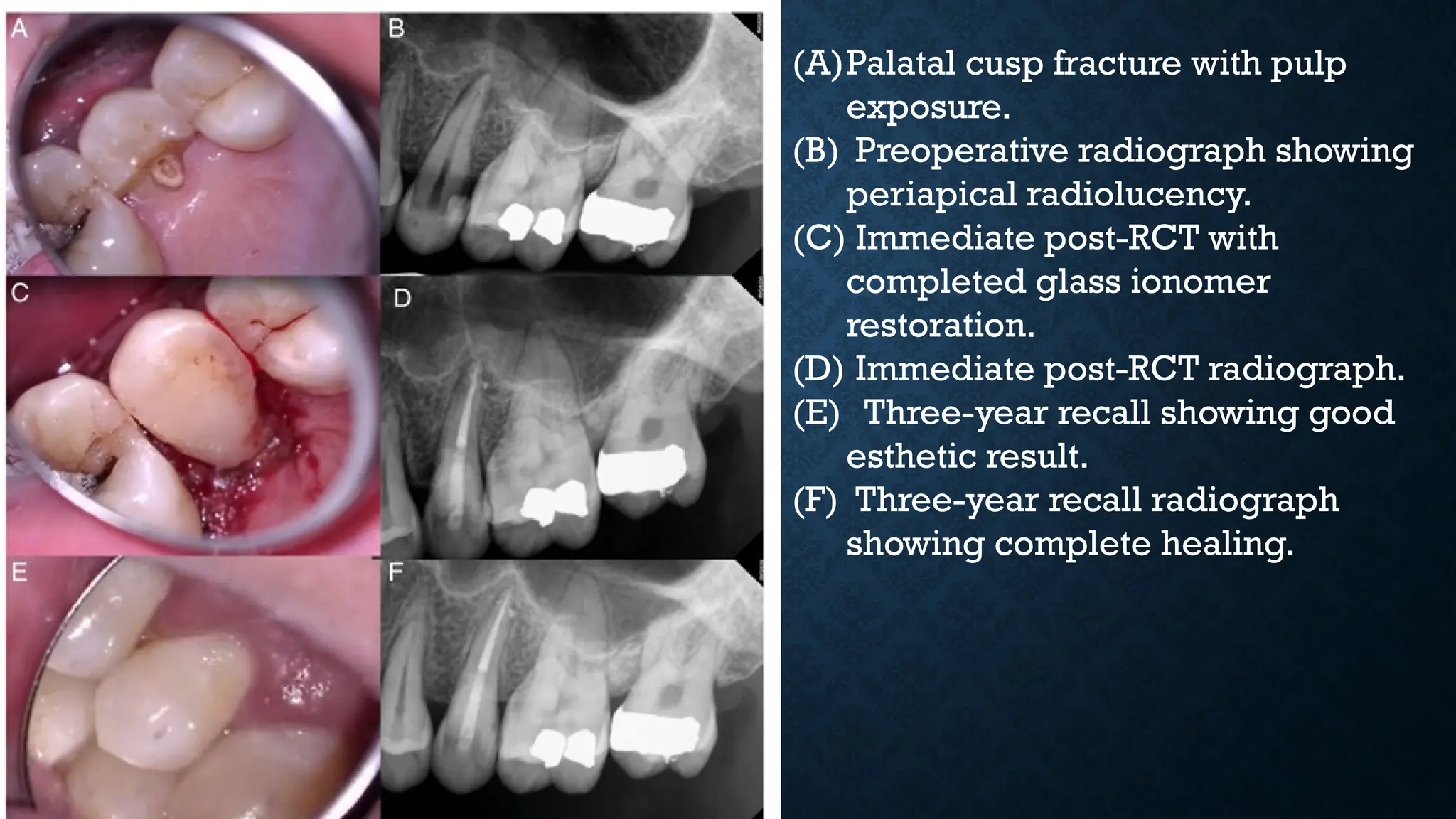 MANAGEMENT OF DEEP SUBGINGIVAL FRACTURES JC.pptx