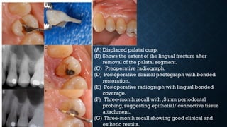 MANAGEMENT OF DEEP SUBGINGIVAL FRACTURES JC.pptx