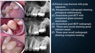 MANAGEMENT OF DEEP SUBGINGIVAL FRACTURES JC.pptx