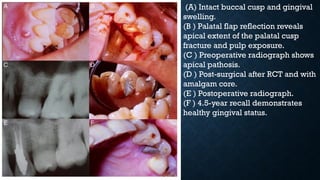 MANAGEMENT OF DEEP SUBGINGIVAL FRACTURES JC.pptx
