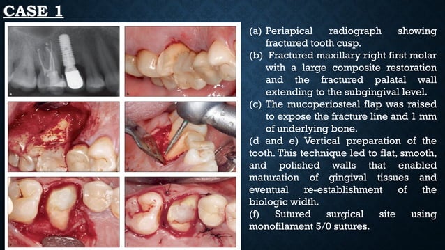 MANAGEMENT OF DEEP SUBGINGIVAL FRACTURES JC.pptx