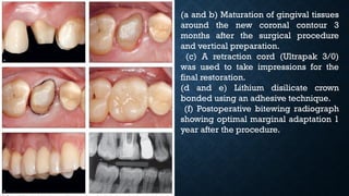 MANAGEMENT OF DEEP SUBGINGIVAL FRACTURES JC.pptx