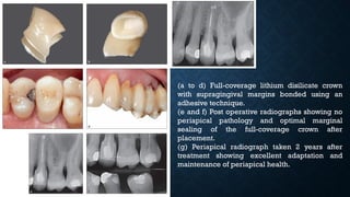 MANAGEMENT OF DEEP SUBGINGIVAL FRACTURES JC.pptx