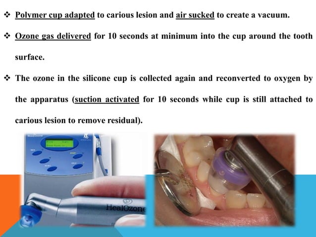 Management of dental caries | PDF | Oral care | Personal Care