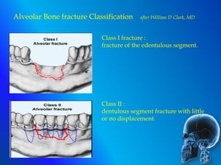 Alveolar Bone Fracture