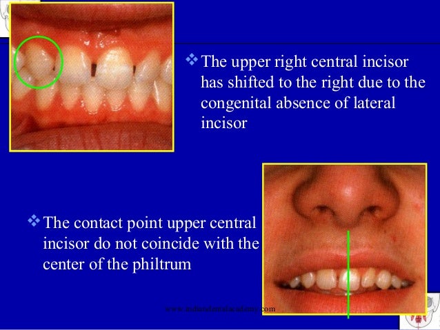 Management of deviated midline