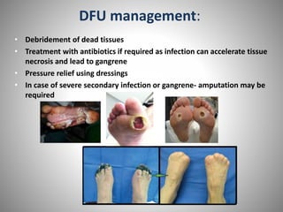 Management of diabetes complication | PPTX