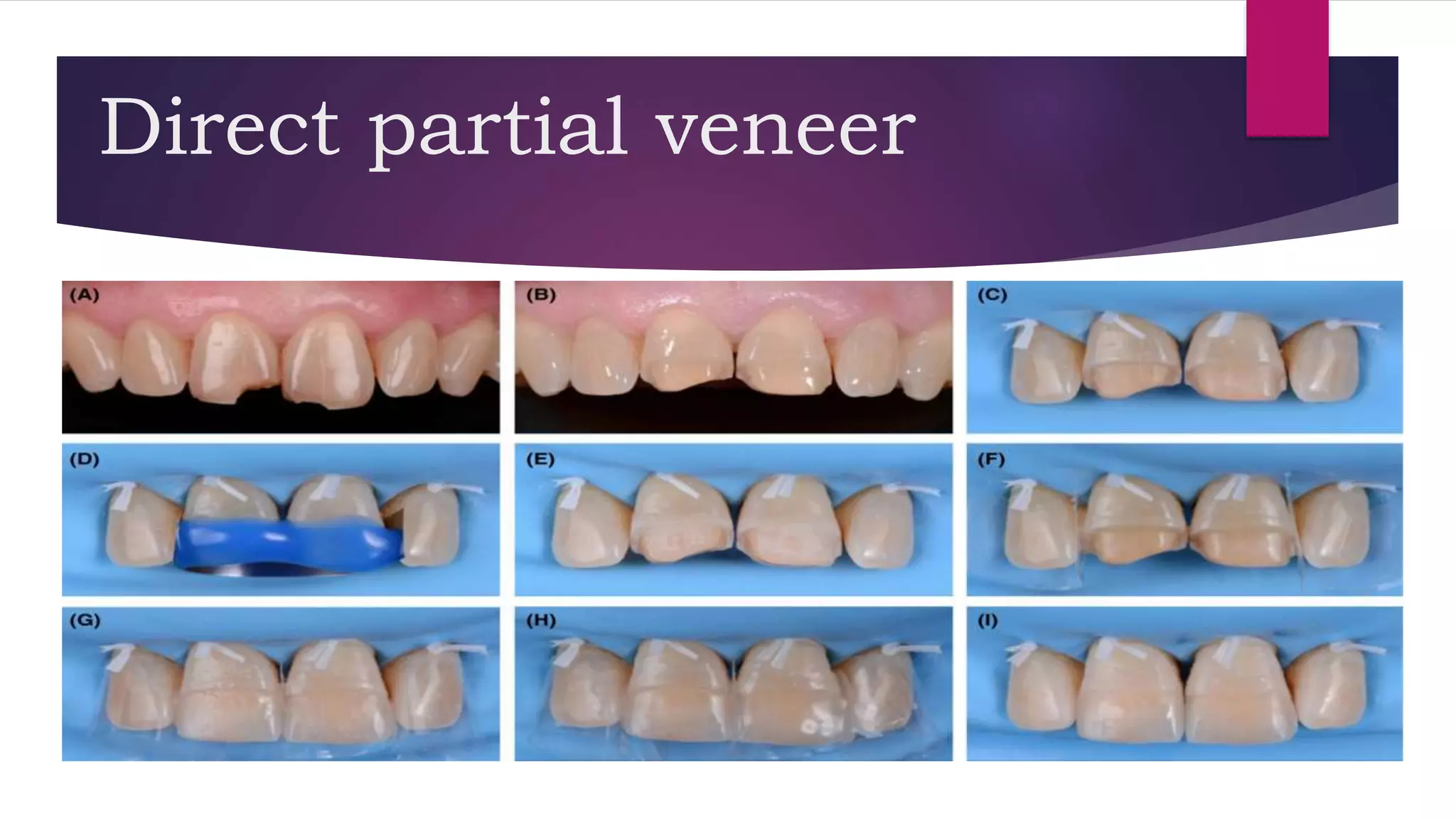 MANAGEMENT OF DISCOLORED TOOTH.pptx