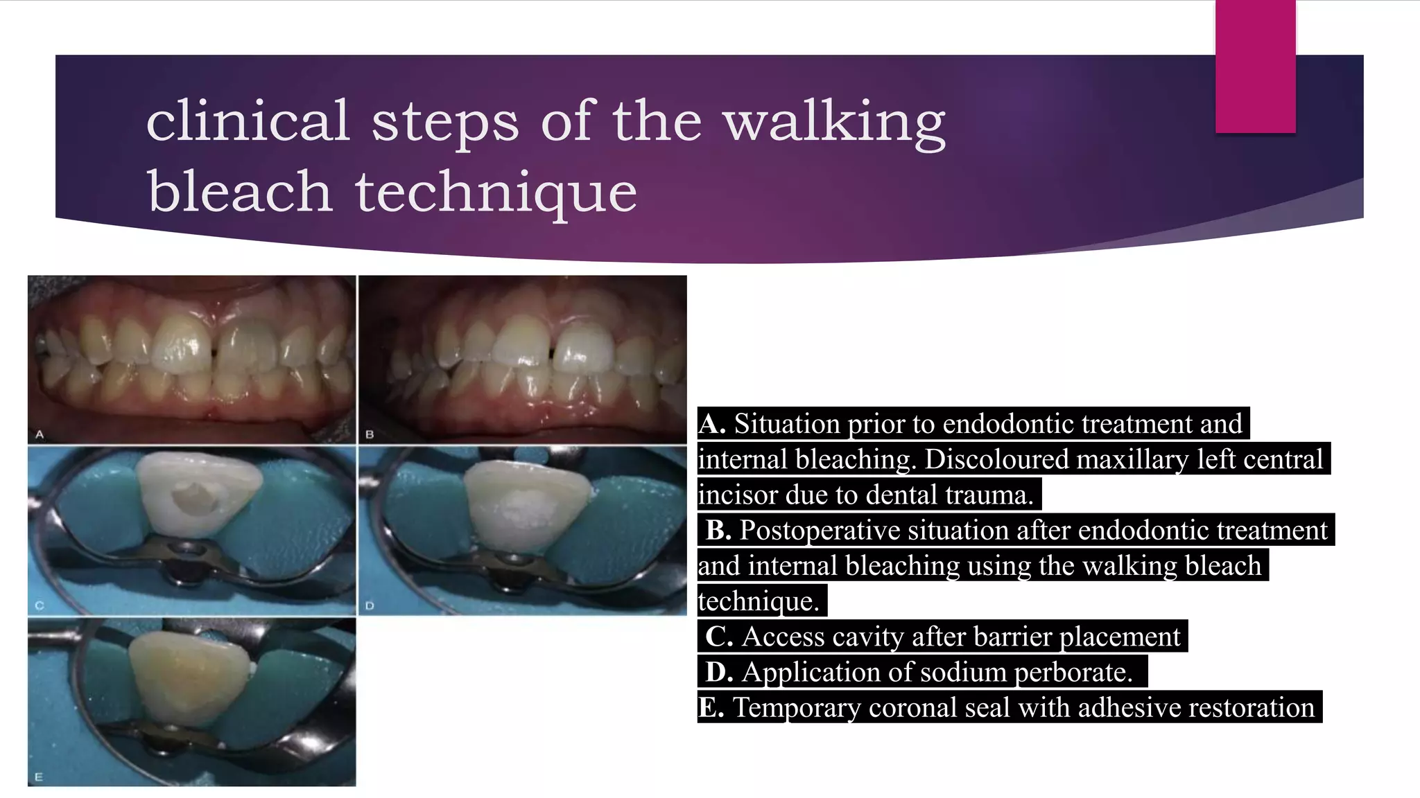 MANAGEMENT OF DISCOLORED TOOTH.pptx
