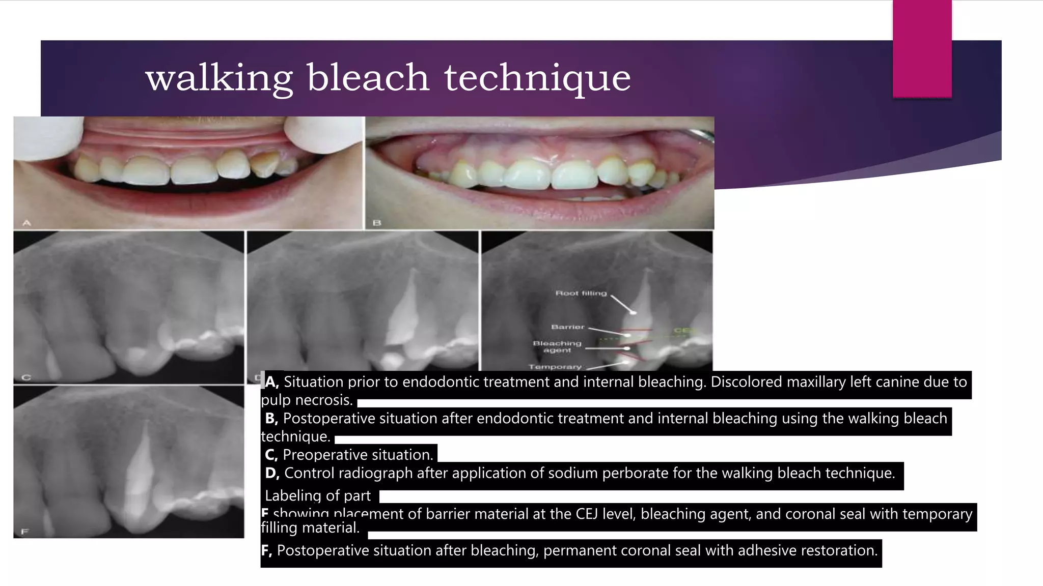 MANAGEMENT OF DISCOLORED TOOTH.pptx