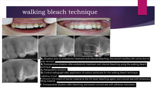 MANAGEMENT OF DISCOLORED TOOTH.pptx