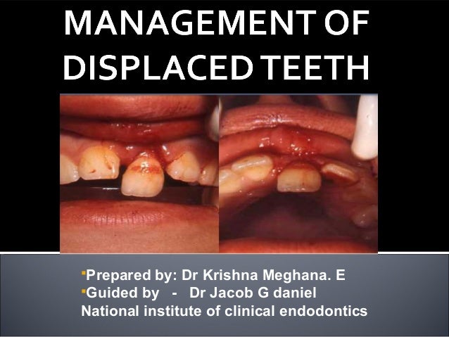 Management of displaced tooth