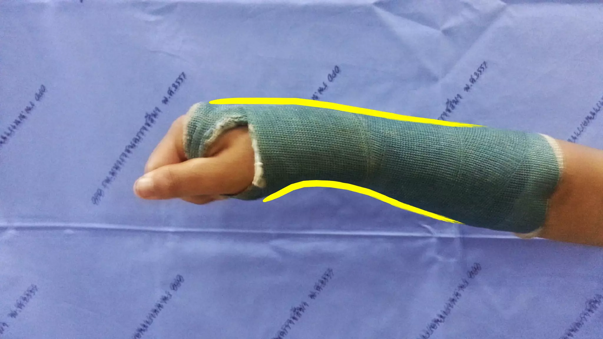 Management of Geriatric Distal Radius Fracture: Now and Then | PDF