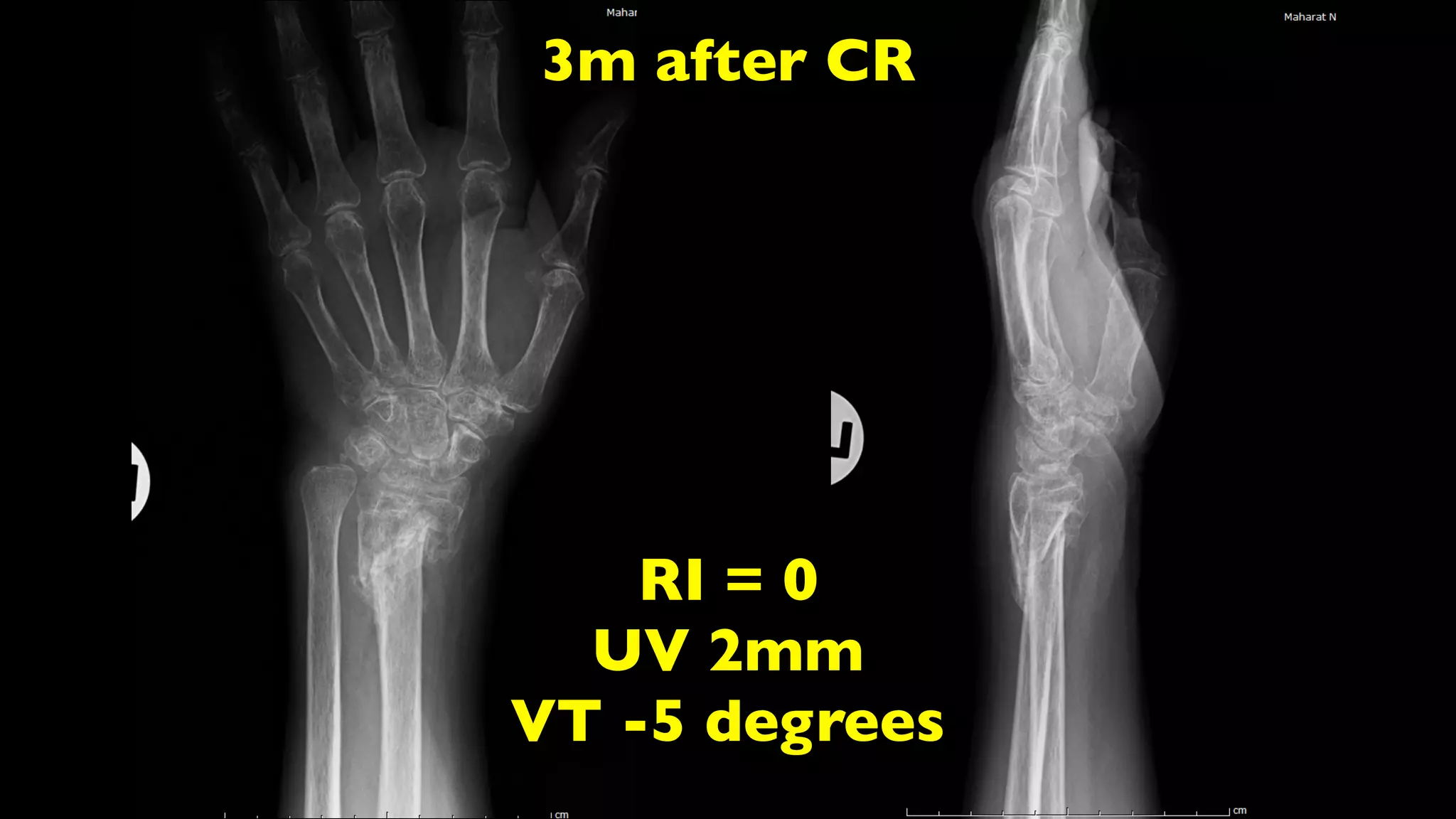 Management of Geriatric Distal Radius Fracture: Now and Then | PDF