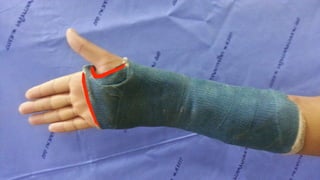 Management of Geriatric Distal Radius Fracture: Now and Then | PDF