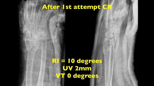 Management of Geriatric Distal Radius Fracture: Now and Then | PDF