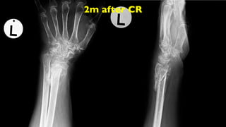 Management of Geriatric Distal Radius Fracture: Now and Then | PDF